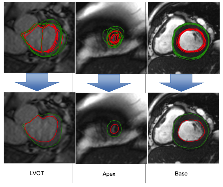 SCMR Consensus Contours - Cardiac Atlas Project