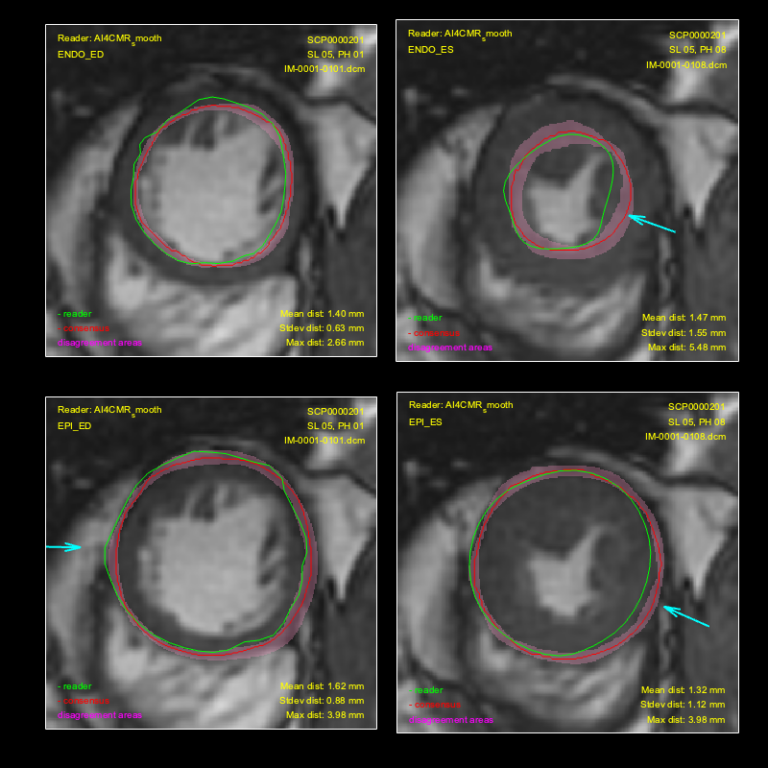 SCMR Consensus Contours - Cardiac Atlas Project