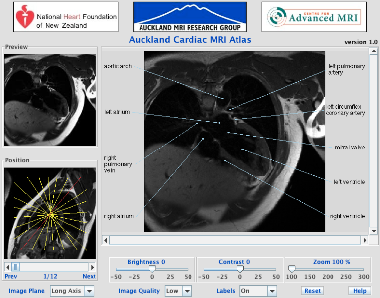 Cardiac Atlas Project - sharing a large-scale database of cardiac ...